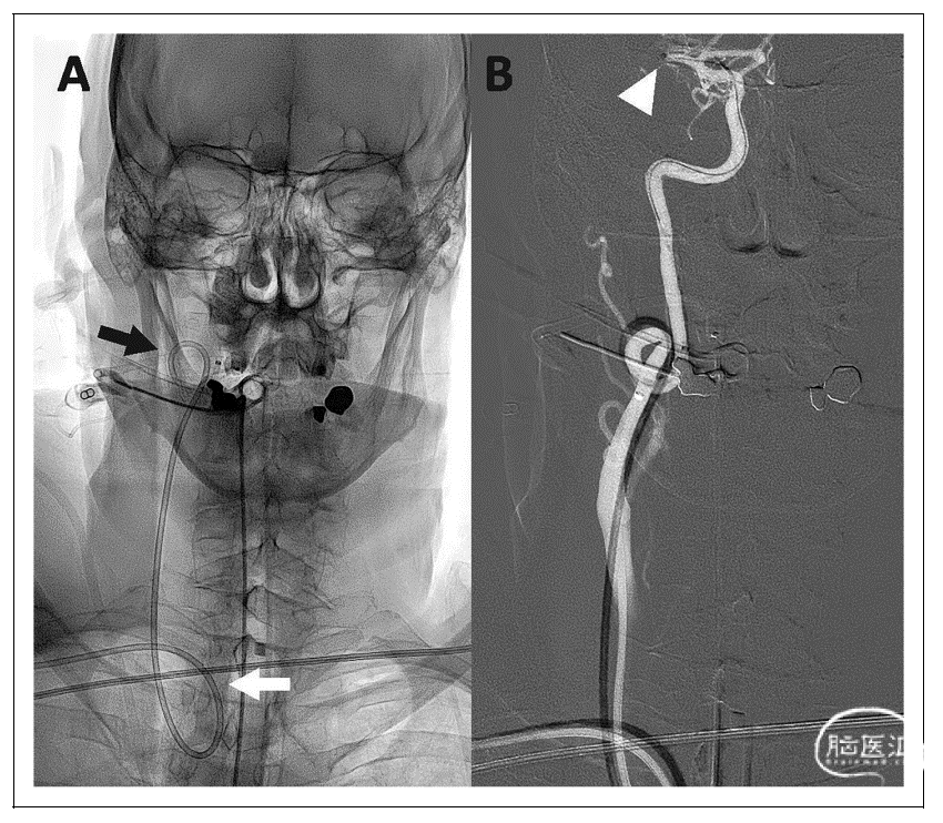 【CNIT专栏】BENCHMARK BMX81在人迹罕至的道路上的实际应用：神经血管介入中桡动脉入路导引导管的比较 - 脑医汇