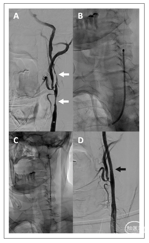 【CNIT专栏】BENCHMARK BMX81在人迹罕至的道路上的实际应用：神经血管介入中桡动脉入路导引导管的比较 - 脑医汇