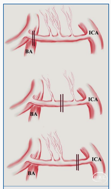 【经典连载】Ali Krisht教授：切断后交通动脉在到达脚间窝入路中的应用：手术技巧和安全性 - 脑医汇 - 神外资讯 - 神介资讯
