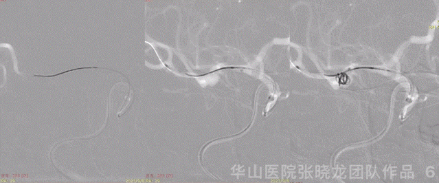 Angioplasty & Large Coil with post-stenting Technique of MCA-AN - 脑医汇