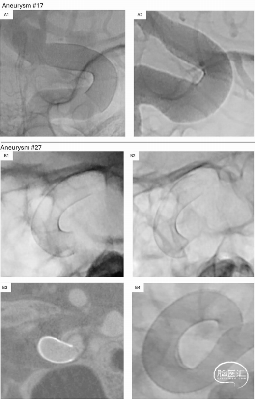 【精选编译】Derivo 2heal栓塞装置治疗颅内动脉瘤的初步结果 - 脑医汇