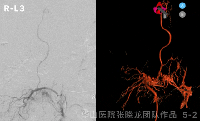 R-L3 SDAVF/SEDAVF & R-T6 SDAVF Embolization - 脑医汇