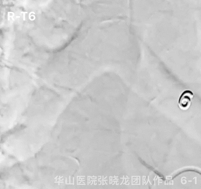 R-L3 SDAVF/SEDAVF & R-T6 SDAVF Embolization - 脑医汇