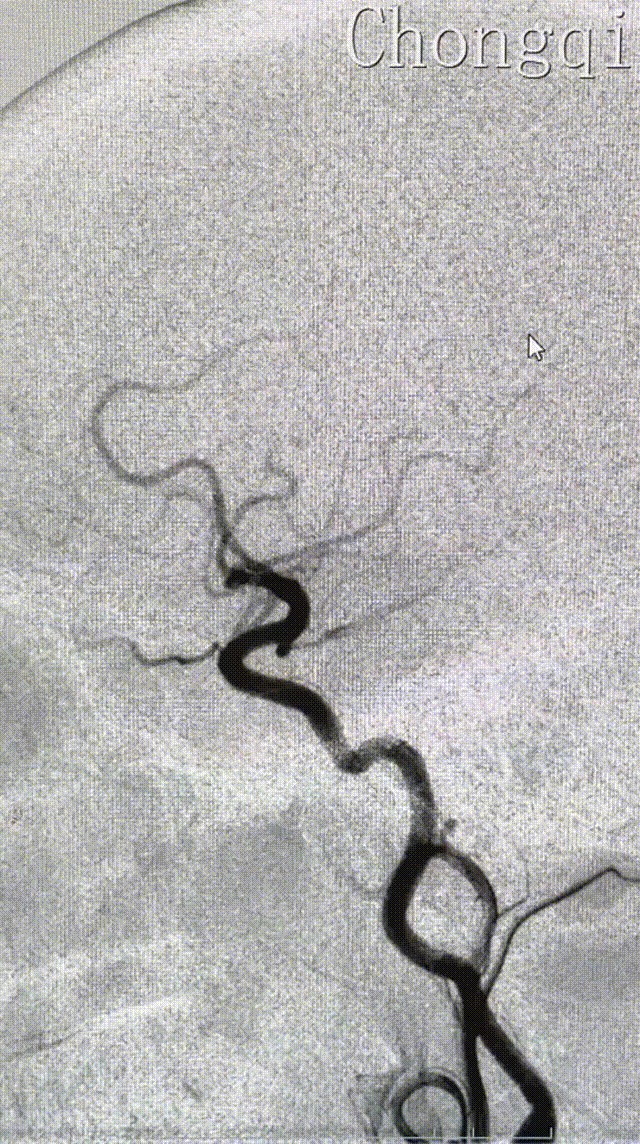 持久塑形 随心所控｜赵泽楠：“精准制导”—Synchro Select导丝联合Atlas支架治疗大脑前动脉A2段动脉瘤 - 脑医汇