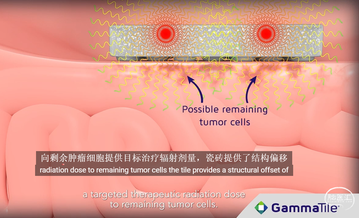 【风向标】助推脑肿瘤术后立即接受近距离放射治疗——永久性植入产品GammaTile®的临床应用达成两项里程碑 - 脑医汇 - 神外资讯 - 神介资讯