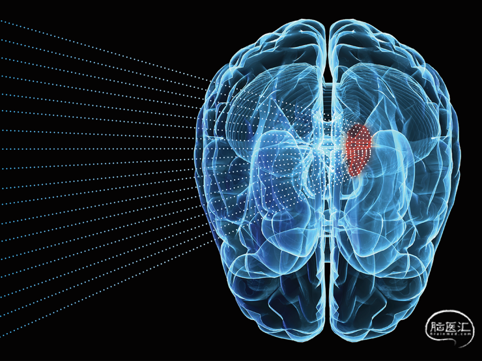 【风向标】Alpheus Medical创新声动力疗法用于复发性高级别胶质瘤的I/II期临床试验揭示出积极的疗效和安全性 - 脑医汇