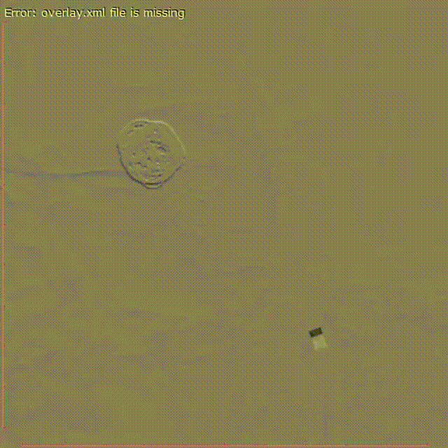 Time to Evolve 超越之旅 | Surpass Evolve支架治疗动脉瘤一例 - 脑医汇