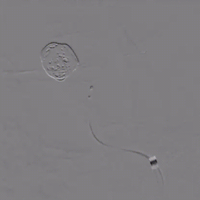 Time to Evolve 超越之旅 | Surpass Evolve支架治疗动脉瘤一例 - 脑医汇