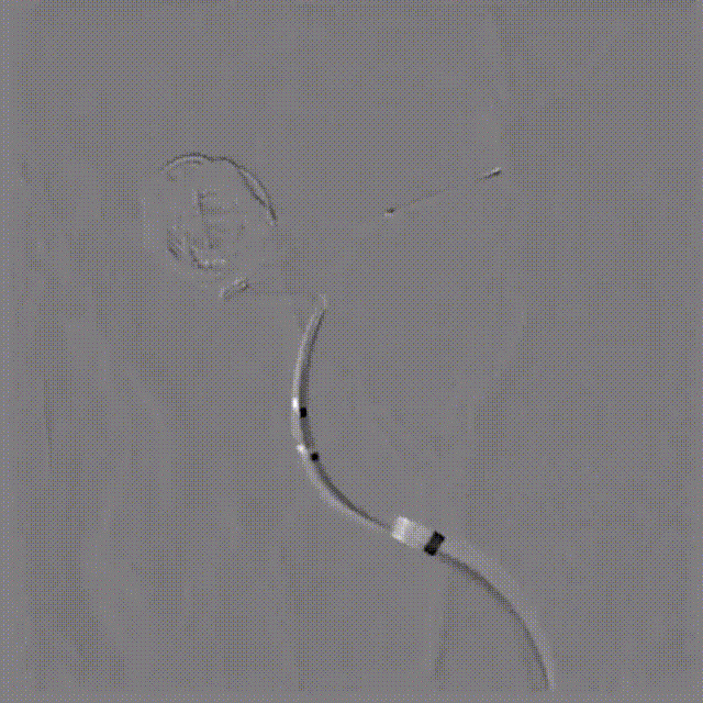 Time to Evolve 超越之旅 | Surpass Evolve支架治疗动脉瘤一例 - 脑医汇