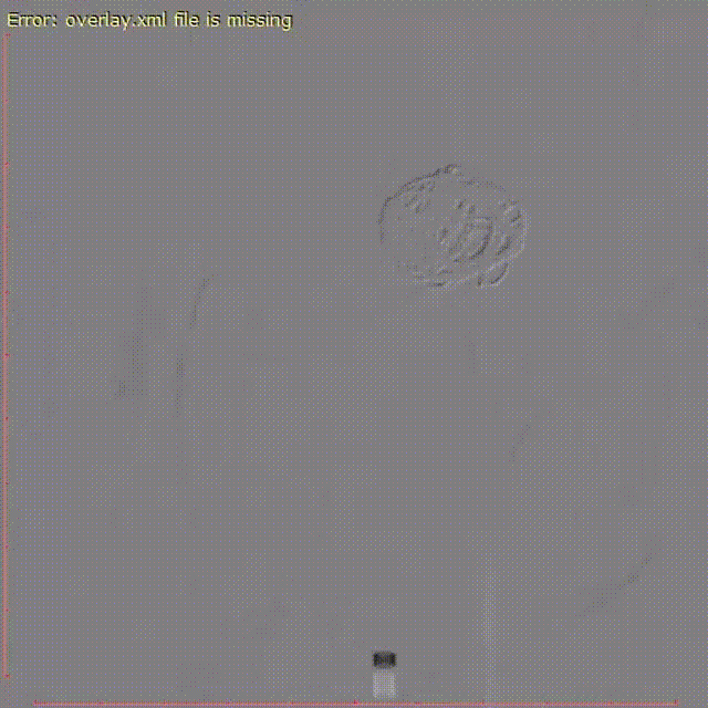 Time to Evolve 超越之旅 | Surpass Evolve支架治疗动脉瘤一例 - 脑医汇