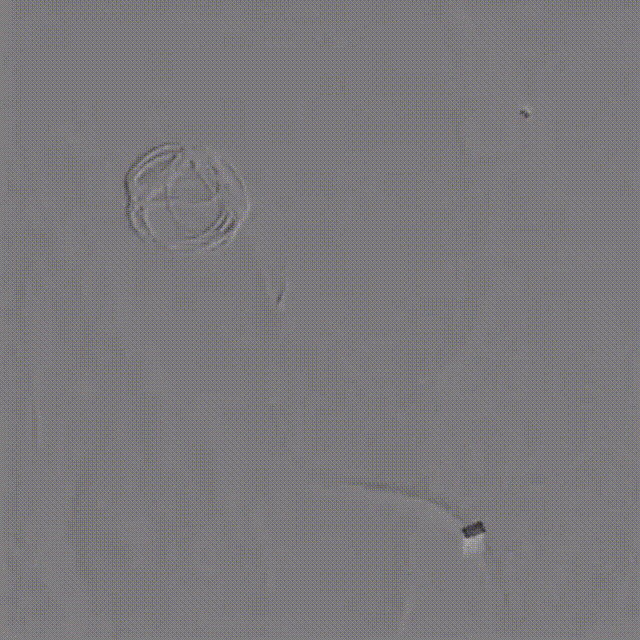 Time to Evolve 超越之旅 | Surpass Evolve支架治疗动脉瘤一例 - 脑医汇