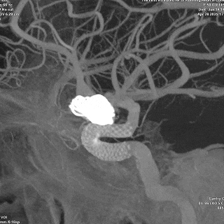 Rist 中国首秀集锦｜左侧ICA-C6段动脉瘤 经桡治疗实况 - 脑医汇