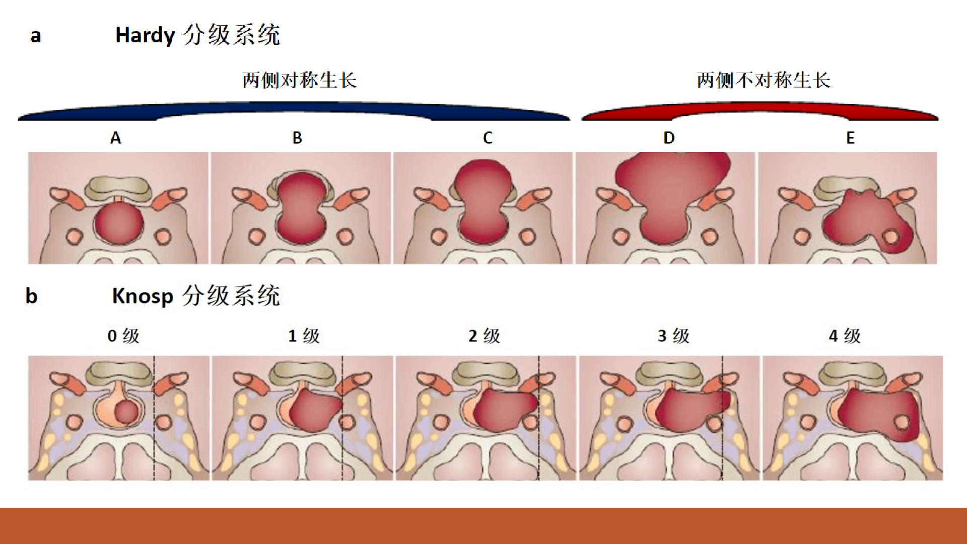 海绵窦解剖与运用：神经内镜切除Knosp IV级垂体瘤 - 脑医汇