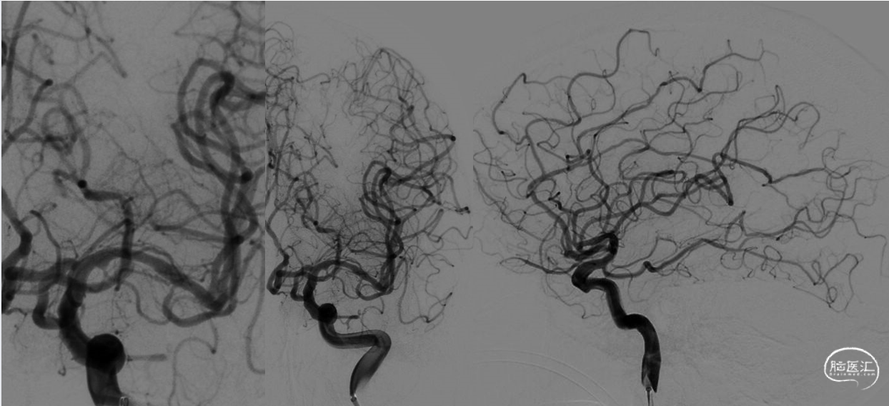 【病例夹】左侧大脑中动脉急诊再通1例 - 脑医汇