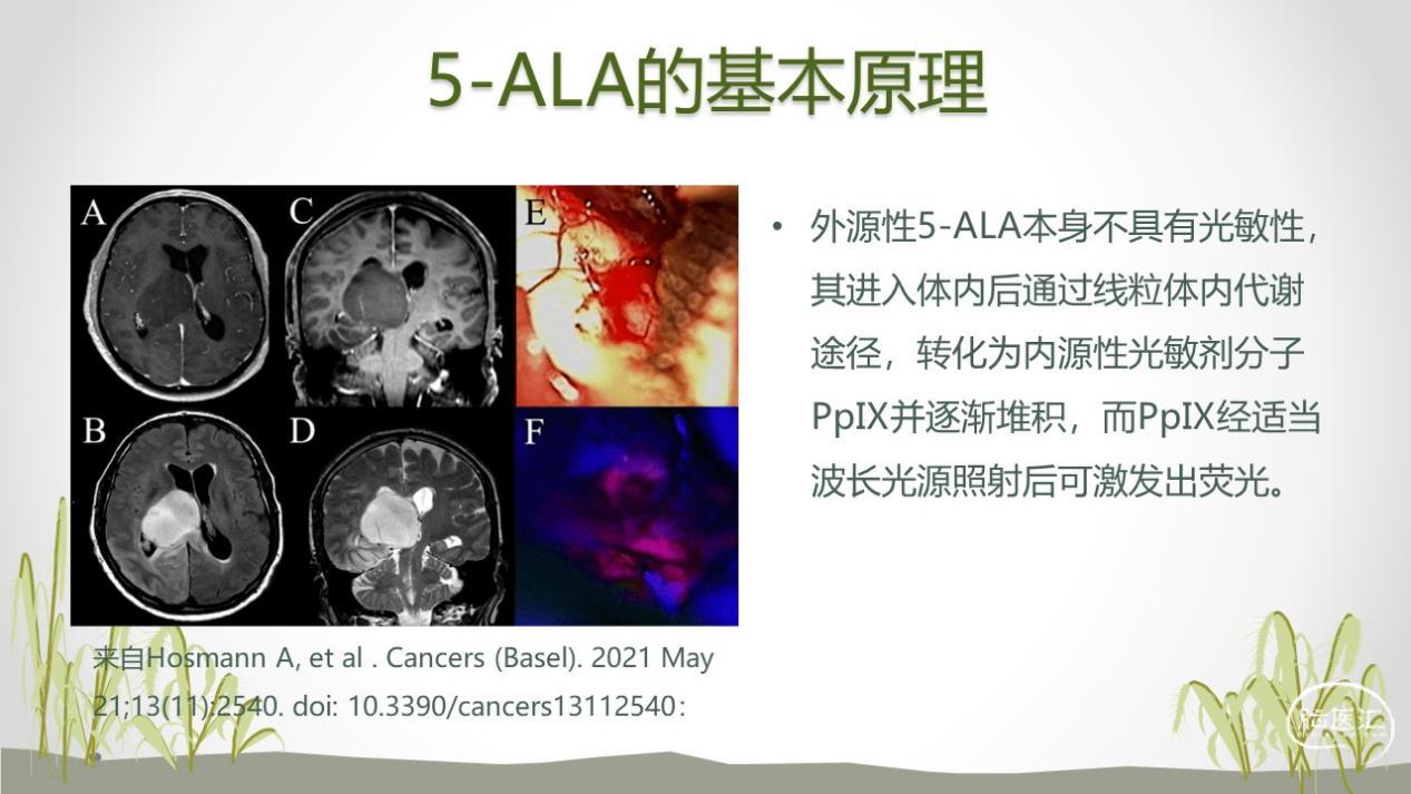 【珠江神经肿瘤外科文献分享周刊】5-ALA诱导的荧光对较低别胶质瘤治疗的临床意义 - 脑医汇