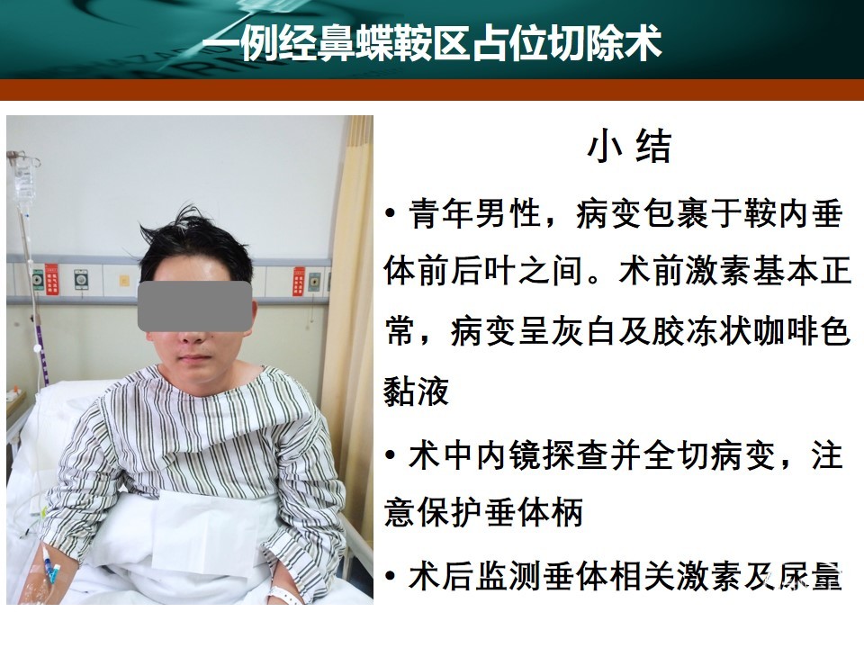 西安交通大学第一附属医院王拓教授团队：一例经鼻蝶鞍区占位切除术 脑医汇 神外资讯 神介资讯
