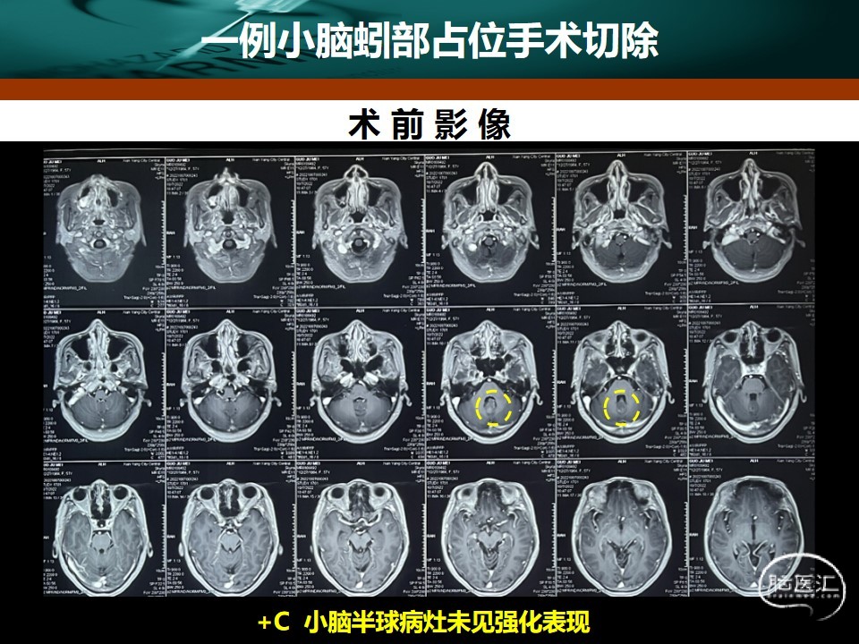 西安交通大学第一附属医院王拓教授团队:一例小脑蚓部占位手术切除 脑医汇