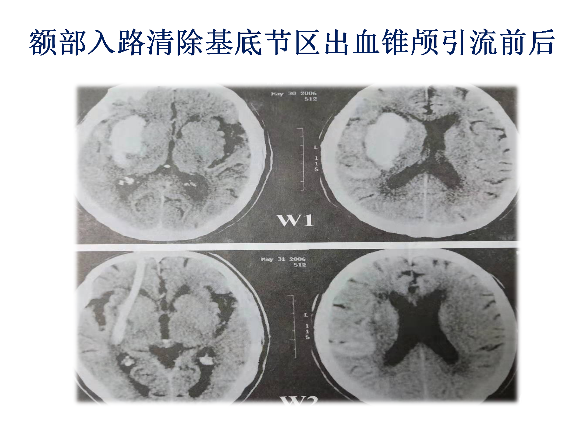 改良立体定位脑出血微创锥颅引流 脑医汇