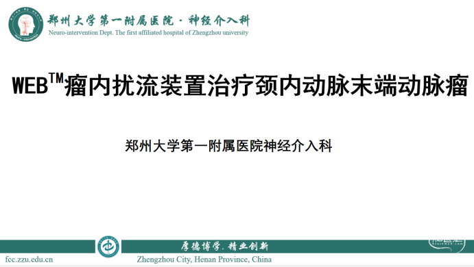 全麻下右侧颈内动脉末端动脉瘤web瘤内扰流装置植入术
