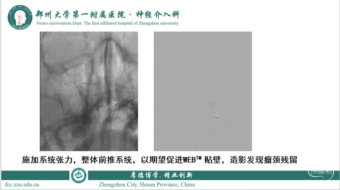 全麻下右侧颈内动脉末端动脉瘤web瘤内扰流装置植入术