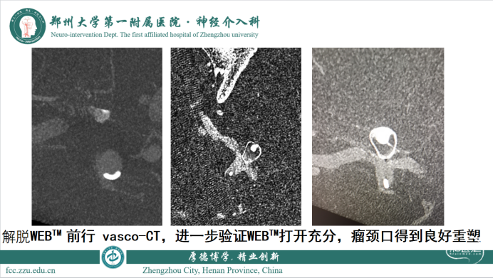 全麻下右侧颈内动脉末端动脉瘤web瘤内扰流装置植入术