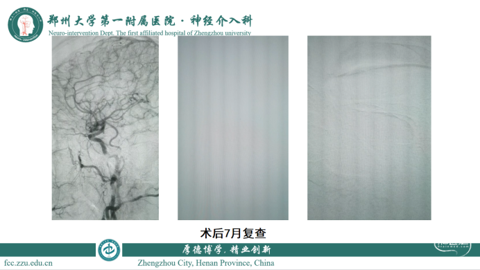 全麻下右侧颈内动脉末端动脉瘤web瘤内扰流装置植入术