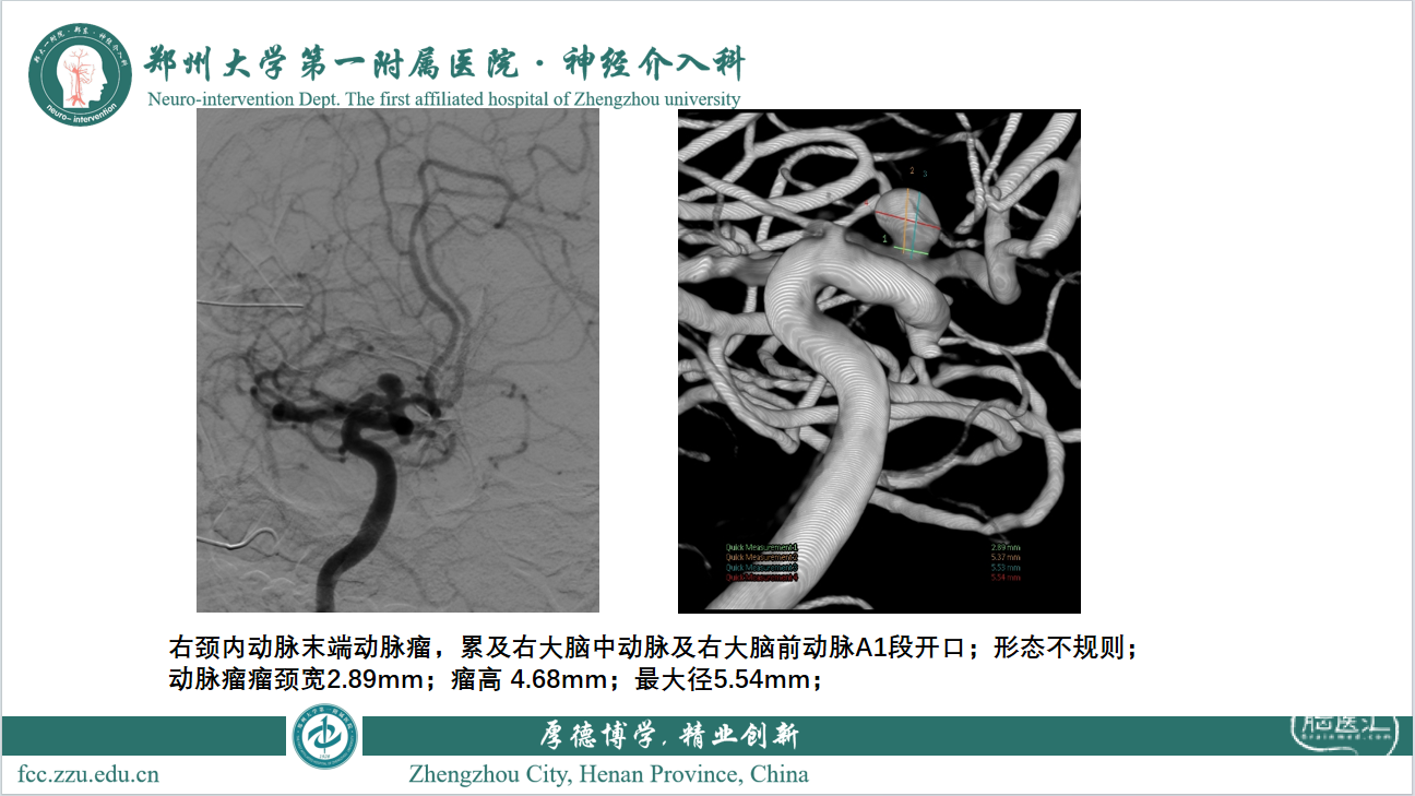全麻下右侧颈内动脉末端动脉瘤web瘤内扰流装置植入术