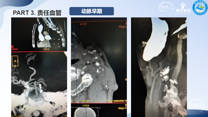 心玮吞川抽吸导管治疗左侧颈动脉串联病变