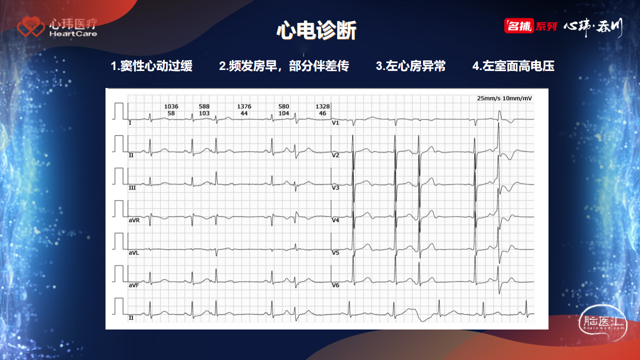 心玮吞川6f颅内血栓抽吸导管应用于基底动脉闭塞取栓一例