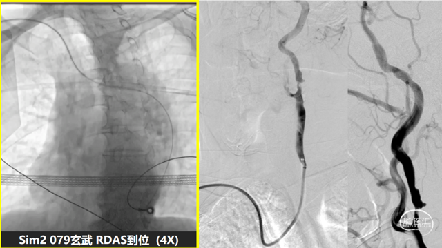 经桡经SIM型5F长鞘ICAS一例