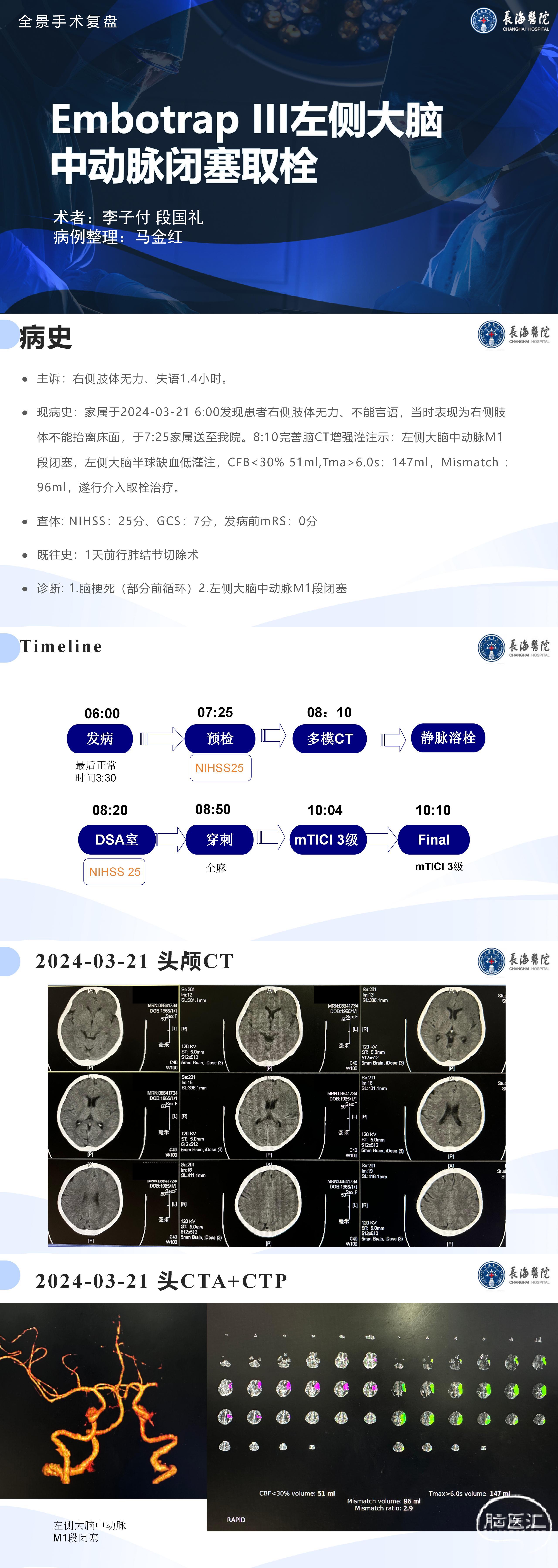 Embotrap III左侧大脑中动脉闭塞取栓
